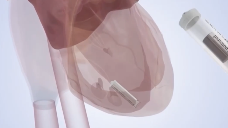 China Unveils Self-Powered Micro Pacemaker, Revolutionizing Cardiac ...
